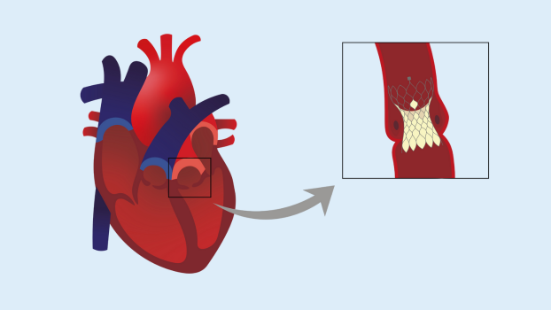 Le CUSM toujours à l'avant-garde de l'innovation en matière de valve ...